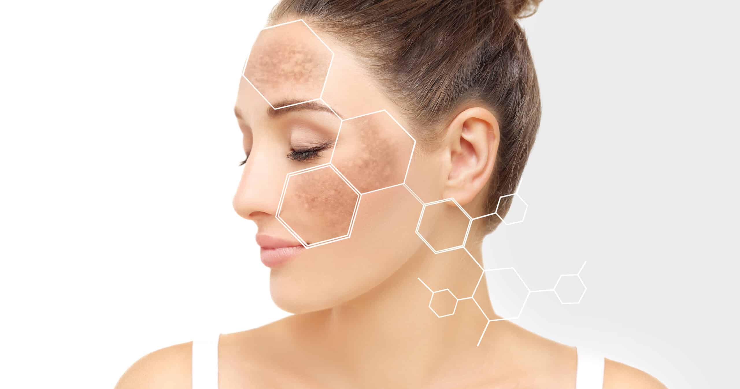 Melasma Treatments in Alpharetta, GA | House of Dermatology